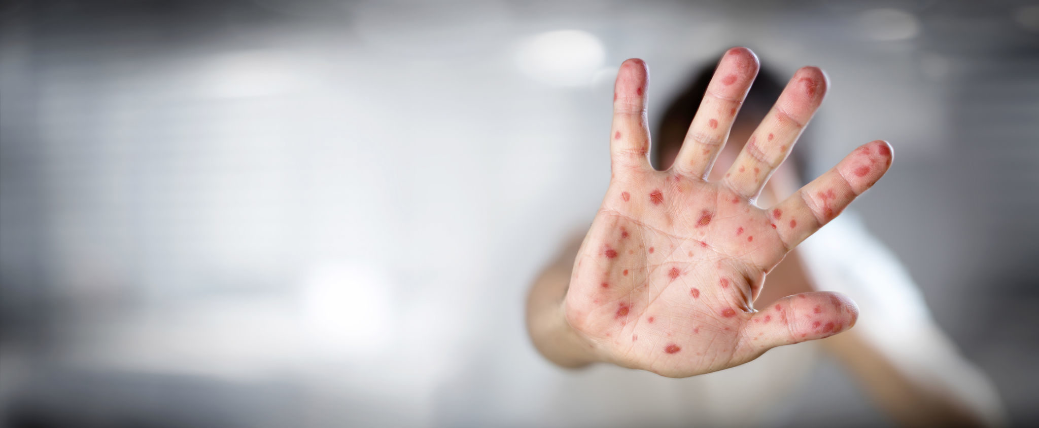 Waarom lukt het niet de mazelen uit te roeien? - EW