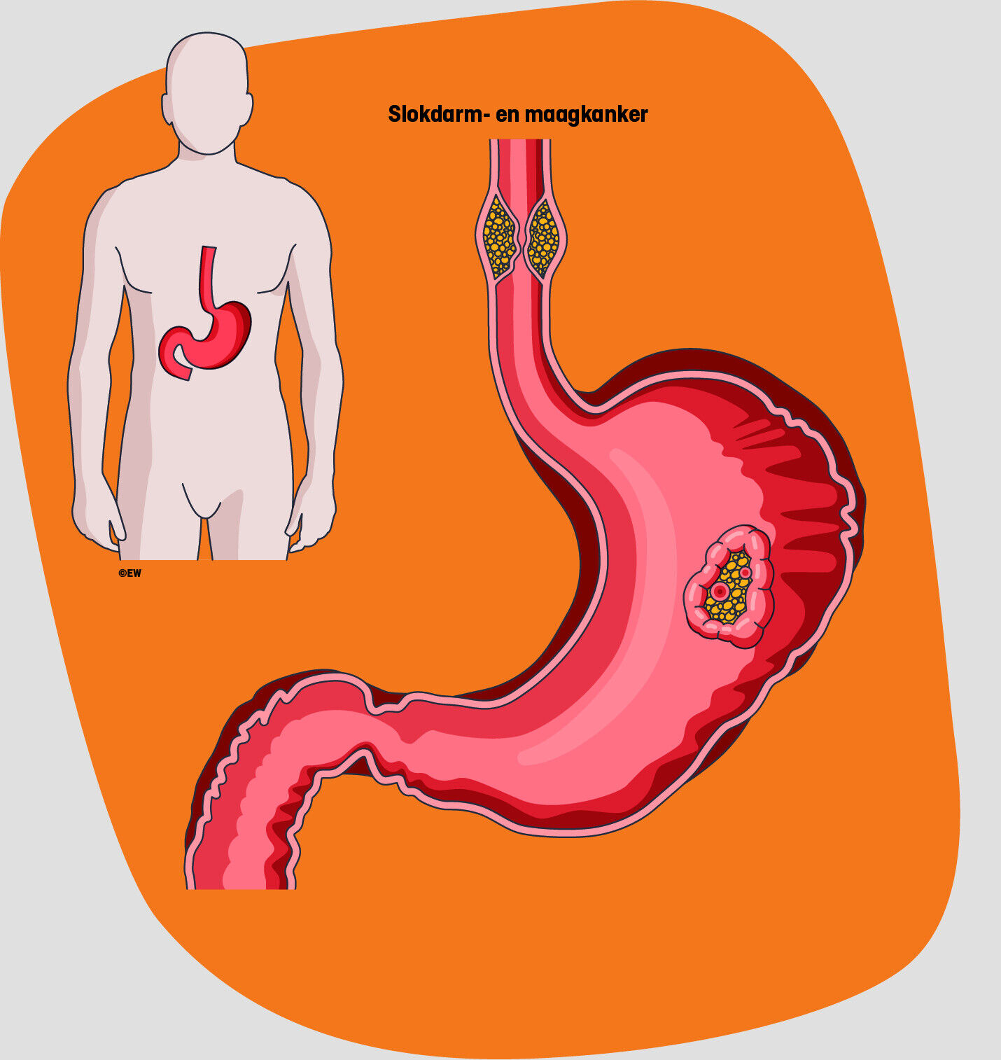 Behandelaars van slokdarm- en maagkanker vergeleken - EW